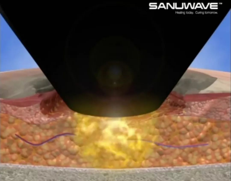 新技术：FDA批准冲击波设备用于治疗糖足溃疡 - 创面科普| 漫舒医疗